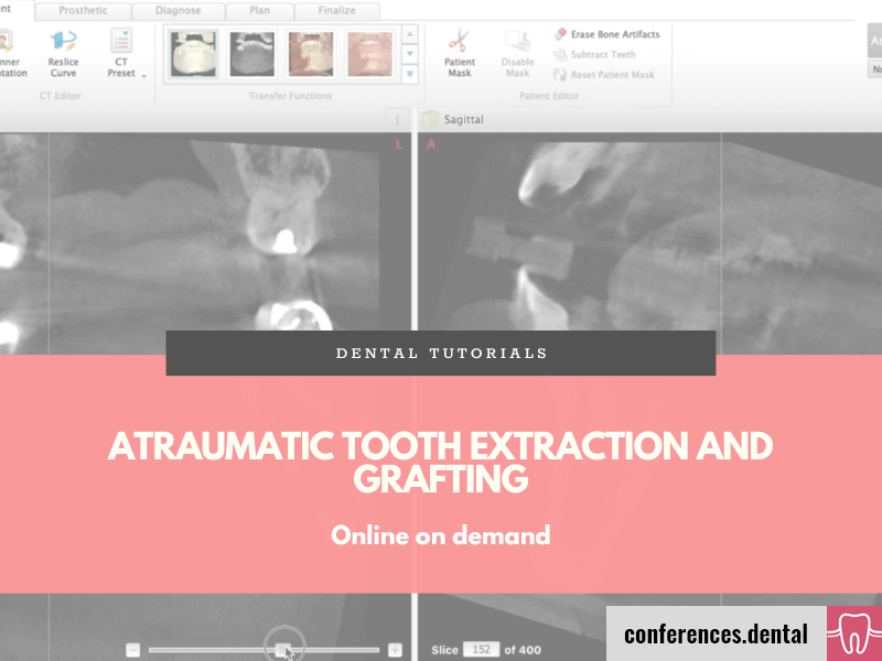 Atraumatic Tooth Extraction with Bone Graft - Part 1 (YouTube) - Dental ...